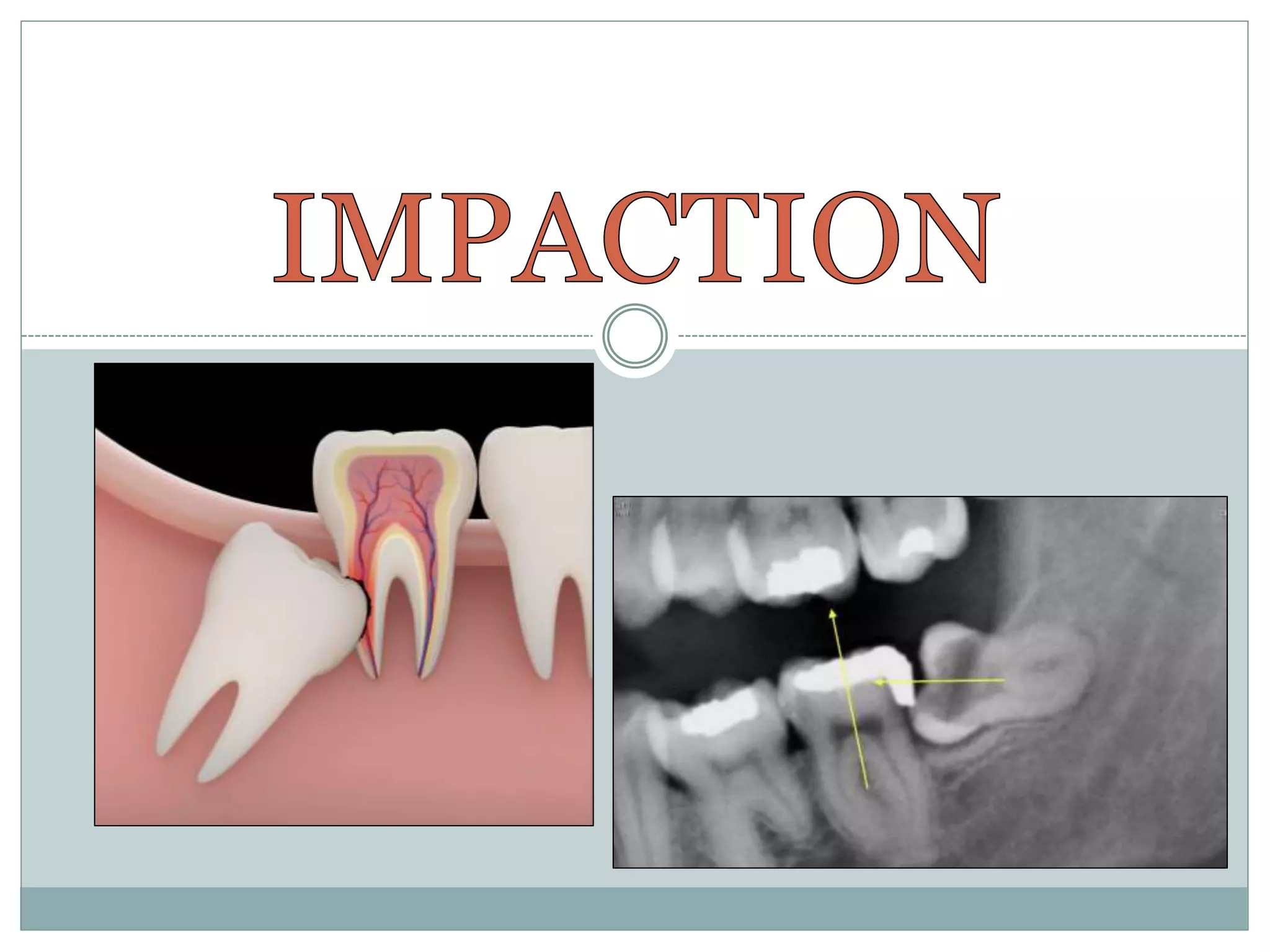 Impaction | PPT