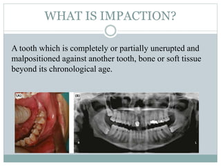 Impaction | PPTX