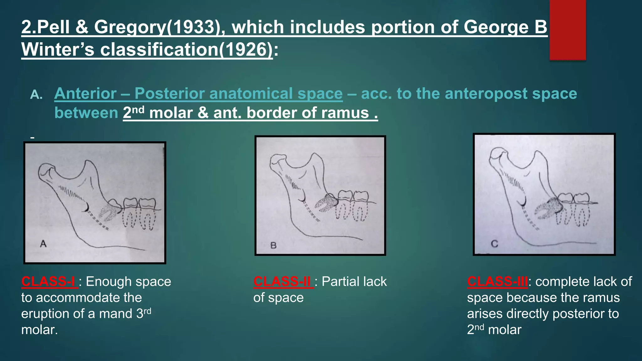 Impaction.pptx