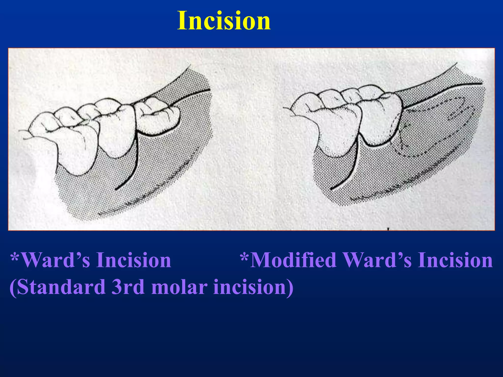 IMPACTION.ppt