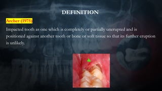 Impaction- definition, theories, indications, surgical techniques | PPTX