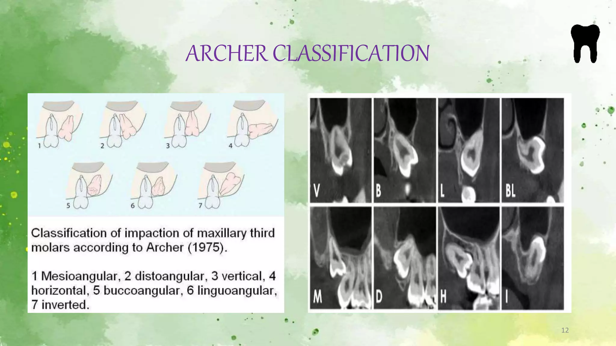 Impaction maxillary teeth part 1 | PPT
