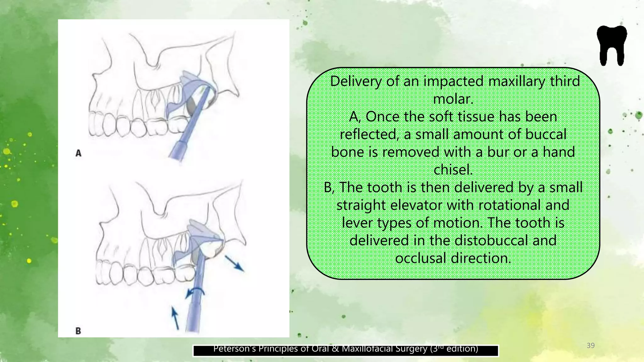 Impaction maxillary teeth part 1 | PPT