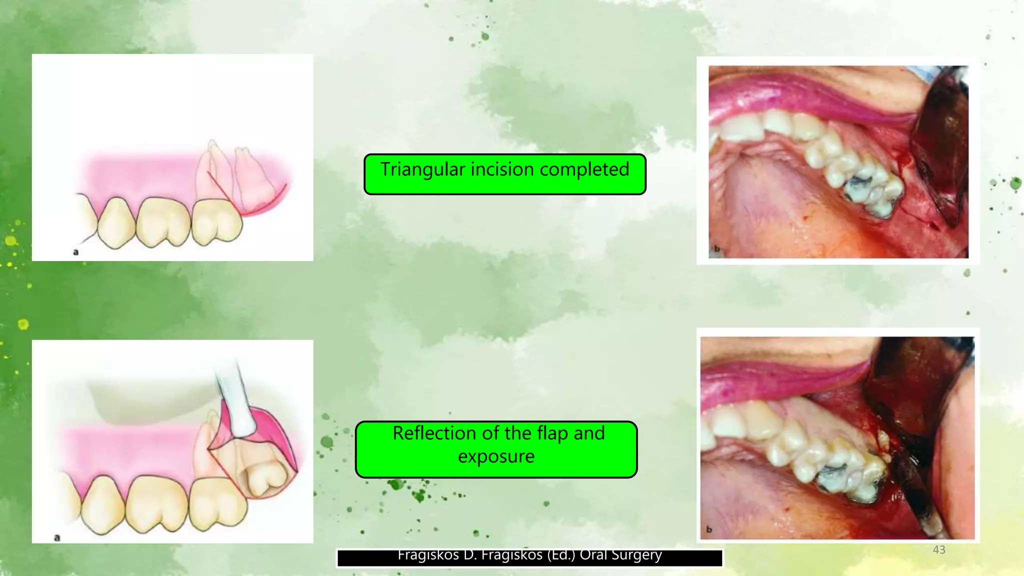 Impaction maxillary teeth part 1 | PPTX