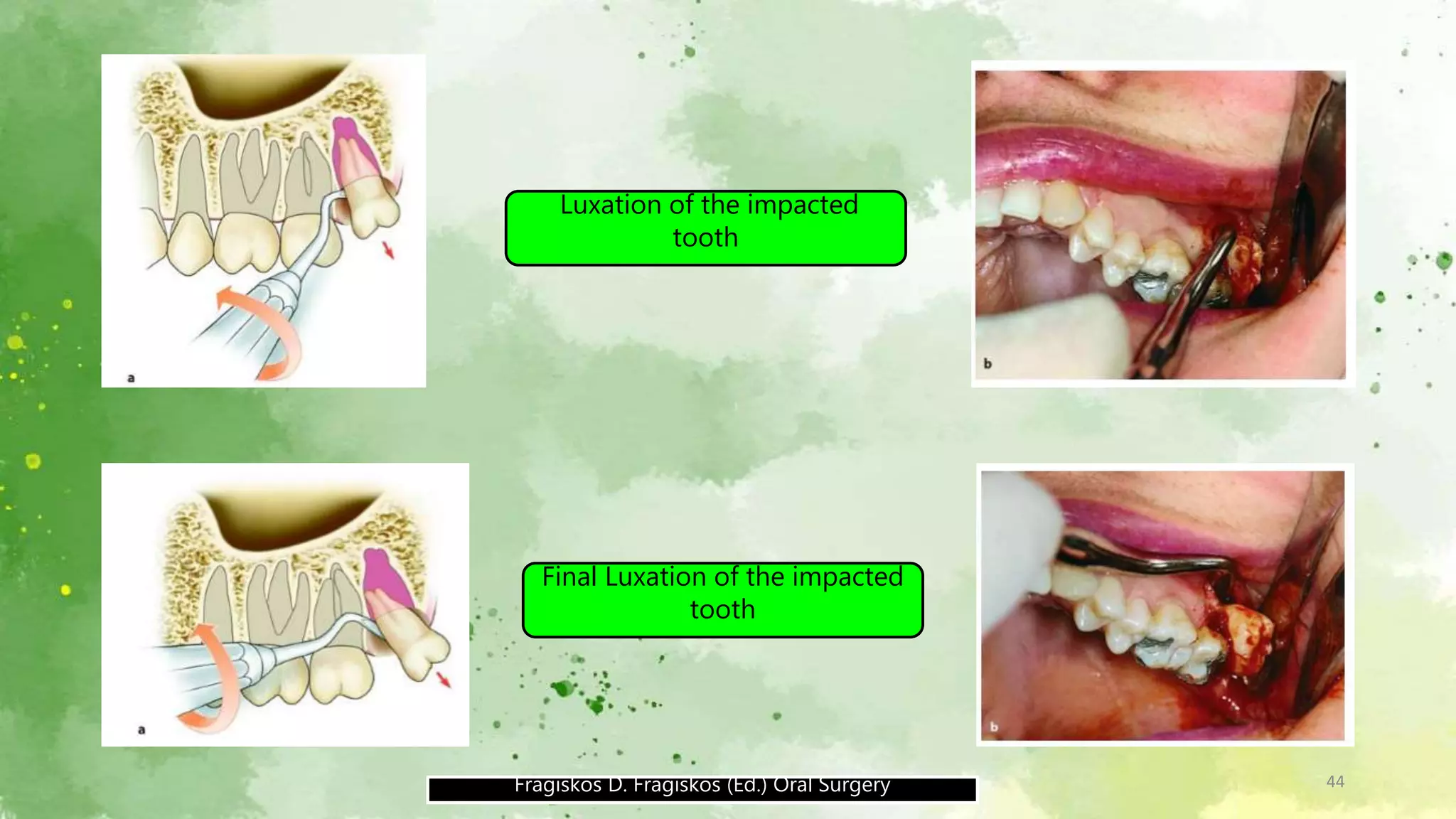 Impaction maxillary teeth part 1 | PPT
