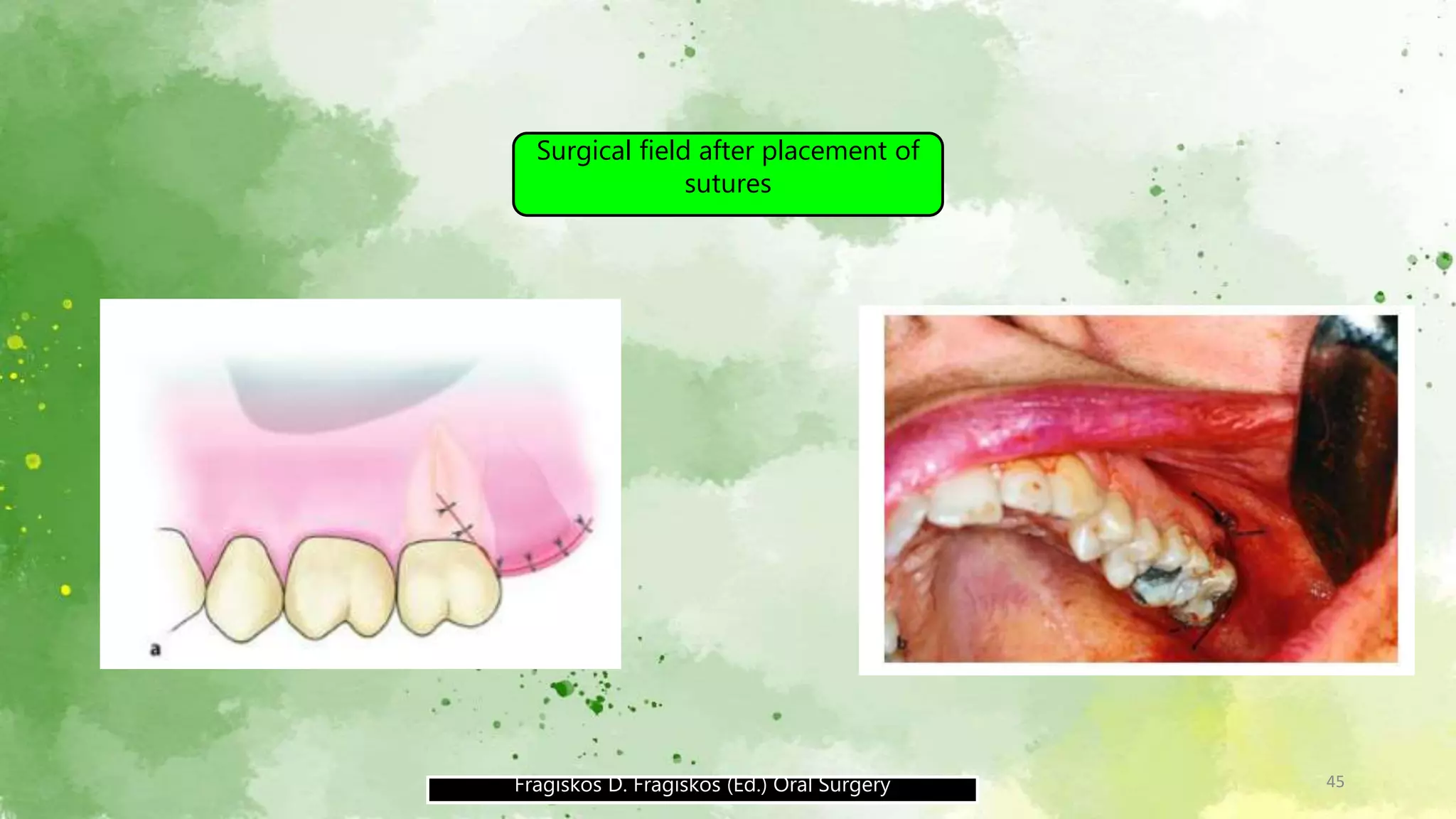 Impaction maxillary teeth part 1 | PPTX