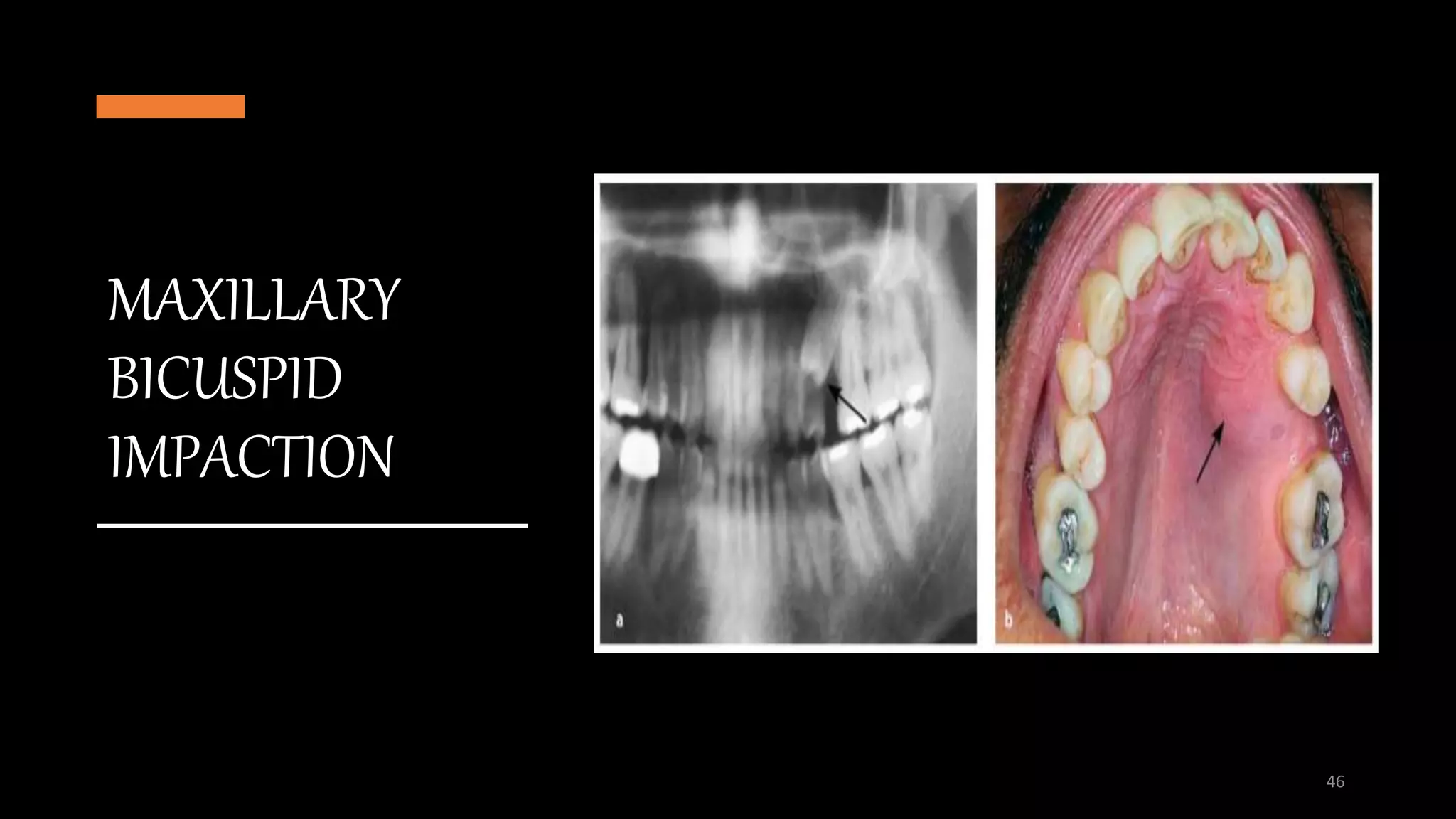 Impaction maxillary teeth part 1 | PPT