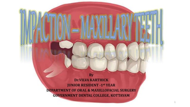 Impaction maxillary teeth part 1 | PPT