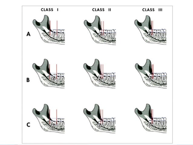 management of Impactions /prosthodontic courses