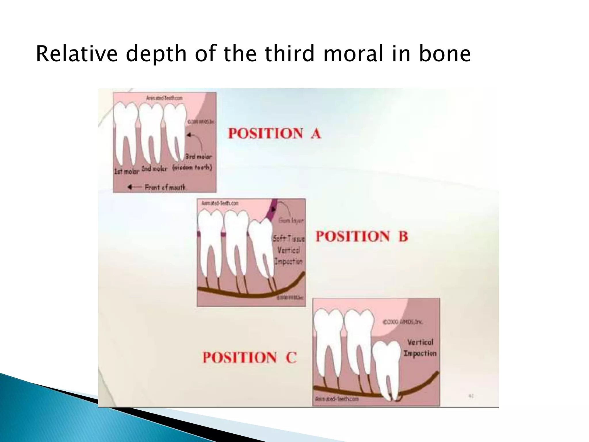 IMPACTION IN ORAL SURGERY UPDATED.pptx