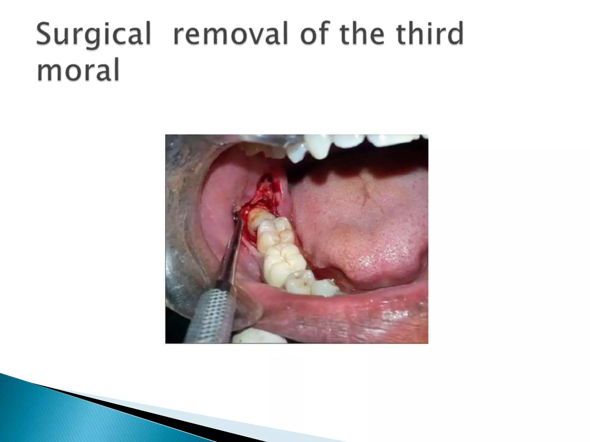 IMPACTION IN ORAL SURGERY UPDATED.pptx