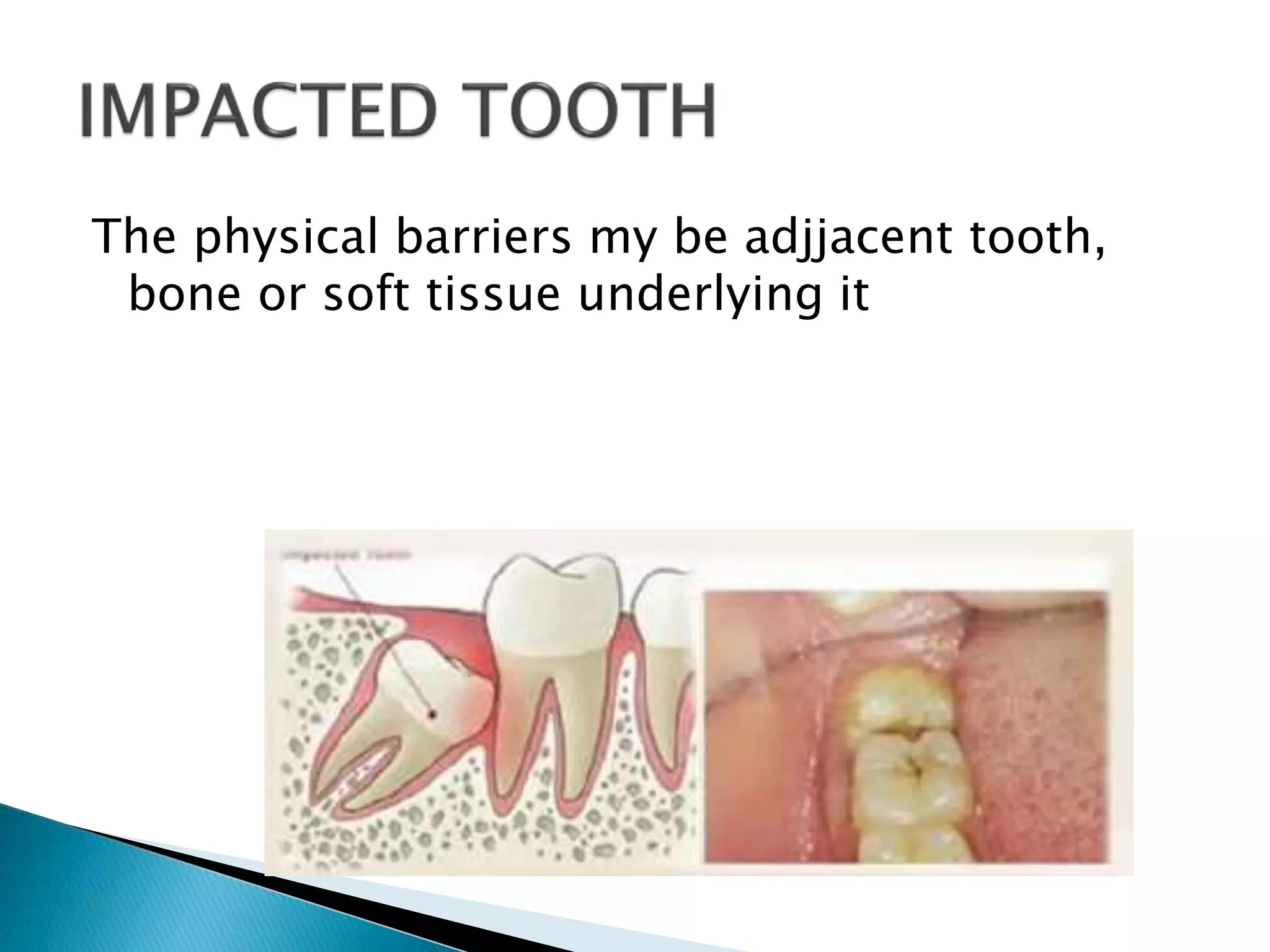 IMPACTION IN ORAL SURGERY UPDATED.pptx