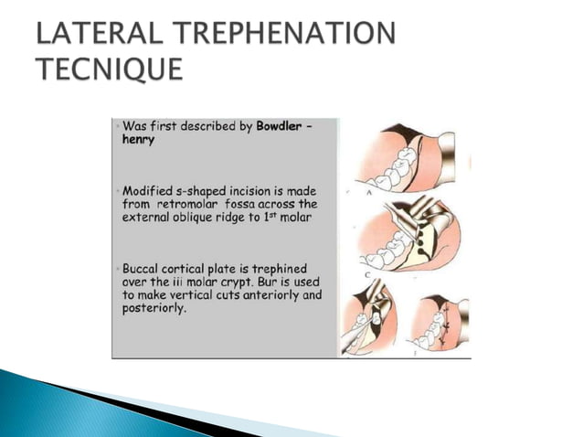 IMPACTION IN ORAL SURGERY UPDATED.pptx