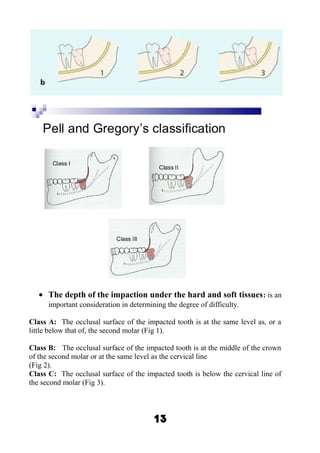 Impaction l1 | PDF
