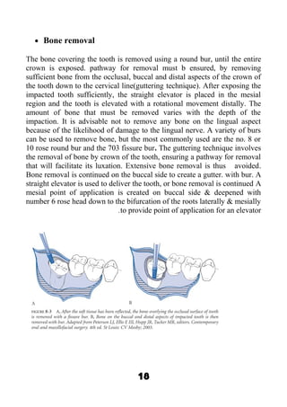Impaction l1 | DOC
