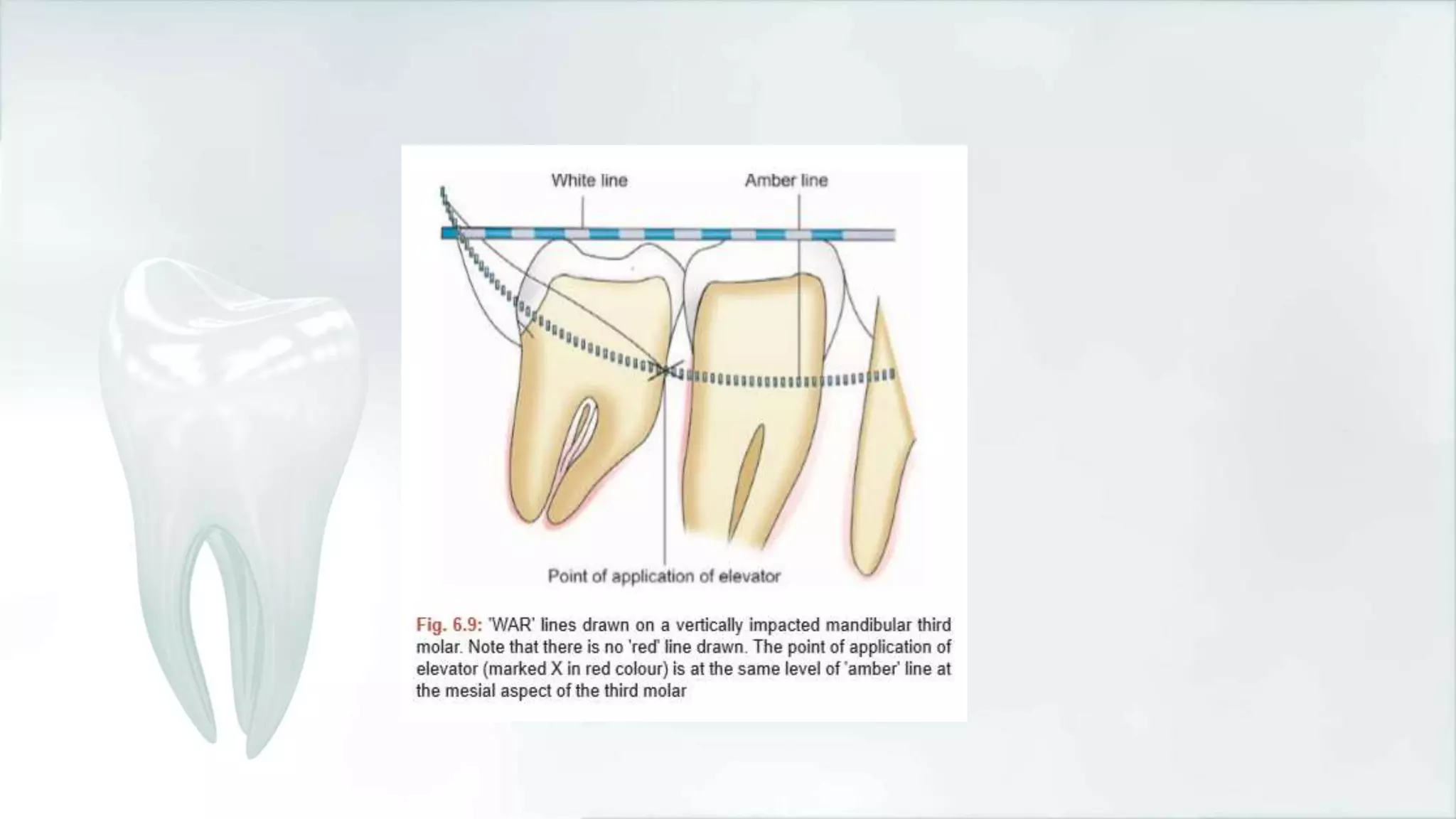 Impaction of mandibular 3rd molar | PPTX