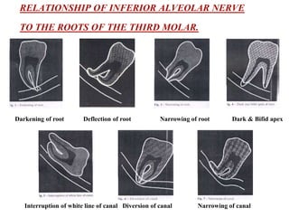 IMPACTION pic PPT.ppt