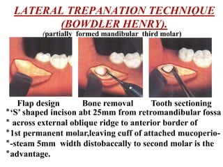 IMPACTION pic PPT.ppt