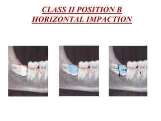 IMPACTION pic PPT.ppt