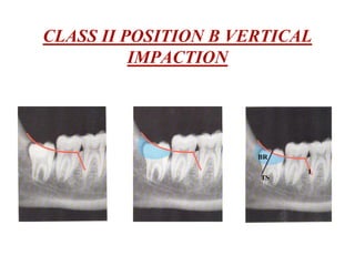 IMPACTION pic PPT.ppt