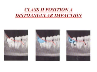 IMPACTION pic PPT.ppt