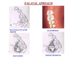 IMPACTION pic PPT.ppt