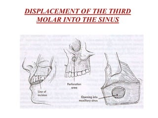 IMPACTION pic PPT.ppt