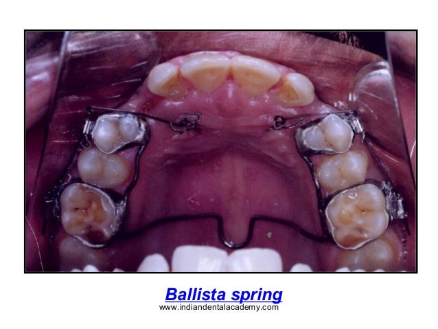 Impactions -orthodontics way