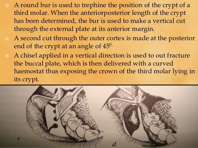 mandibular molar Impactions