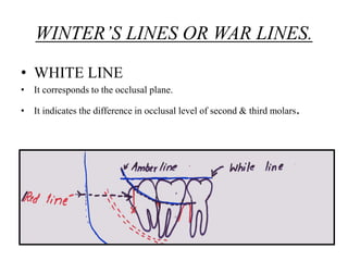Management of Impacted third molars | PPTX