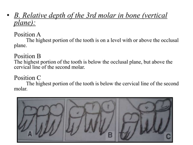 Management of Impacted third molars | PPT