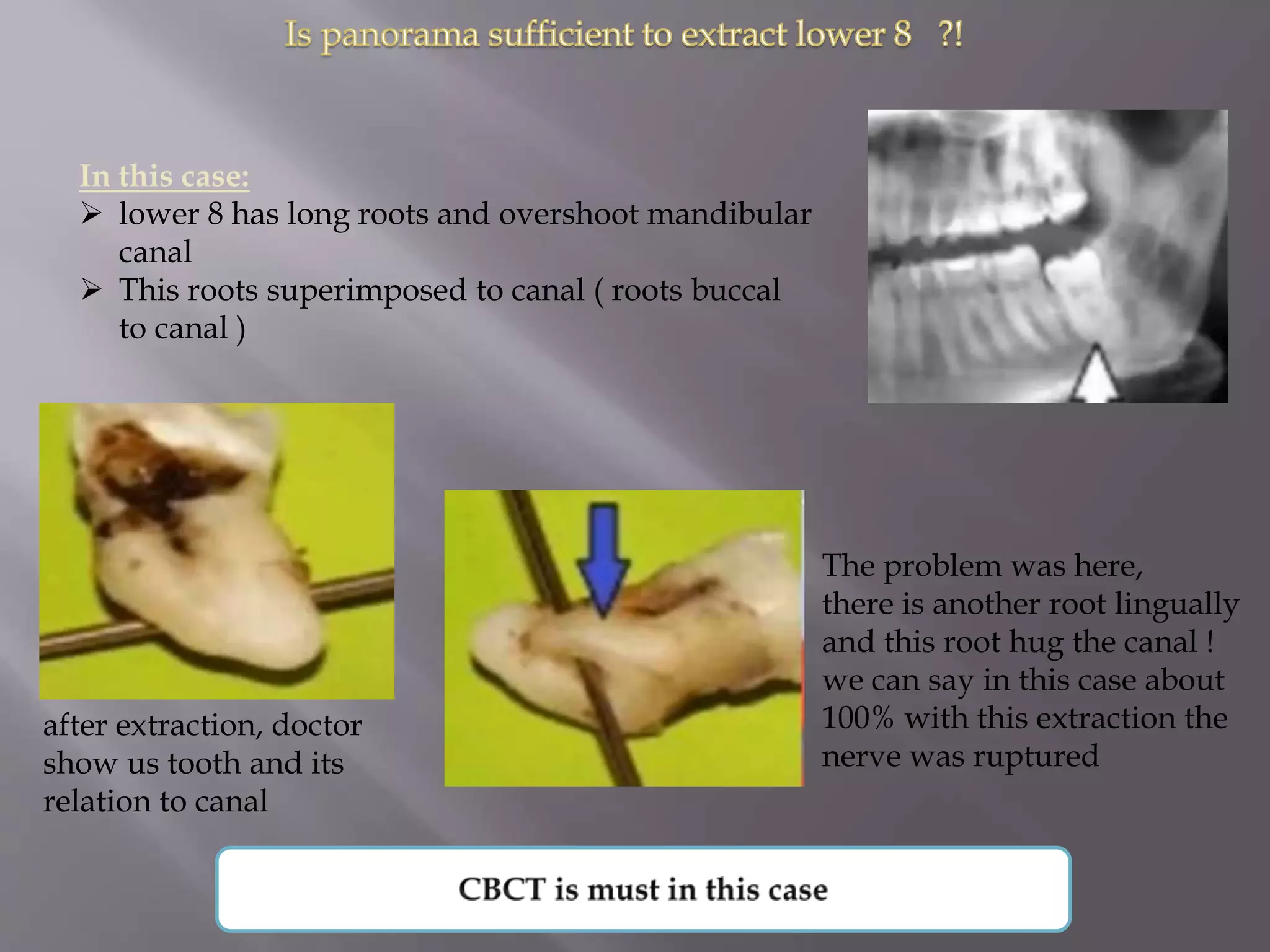 Impaction Tips & Tricks | PPTX