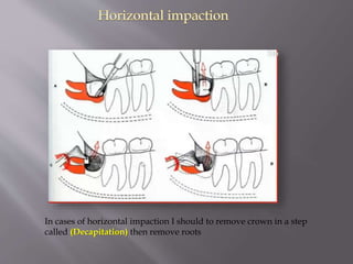 Impaction Tips & Tricks | PPTX