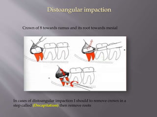 Impaction Tips & Tricks | PPTX