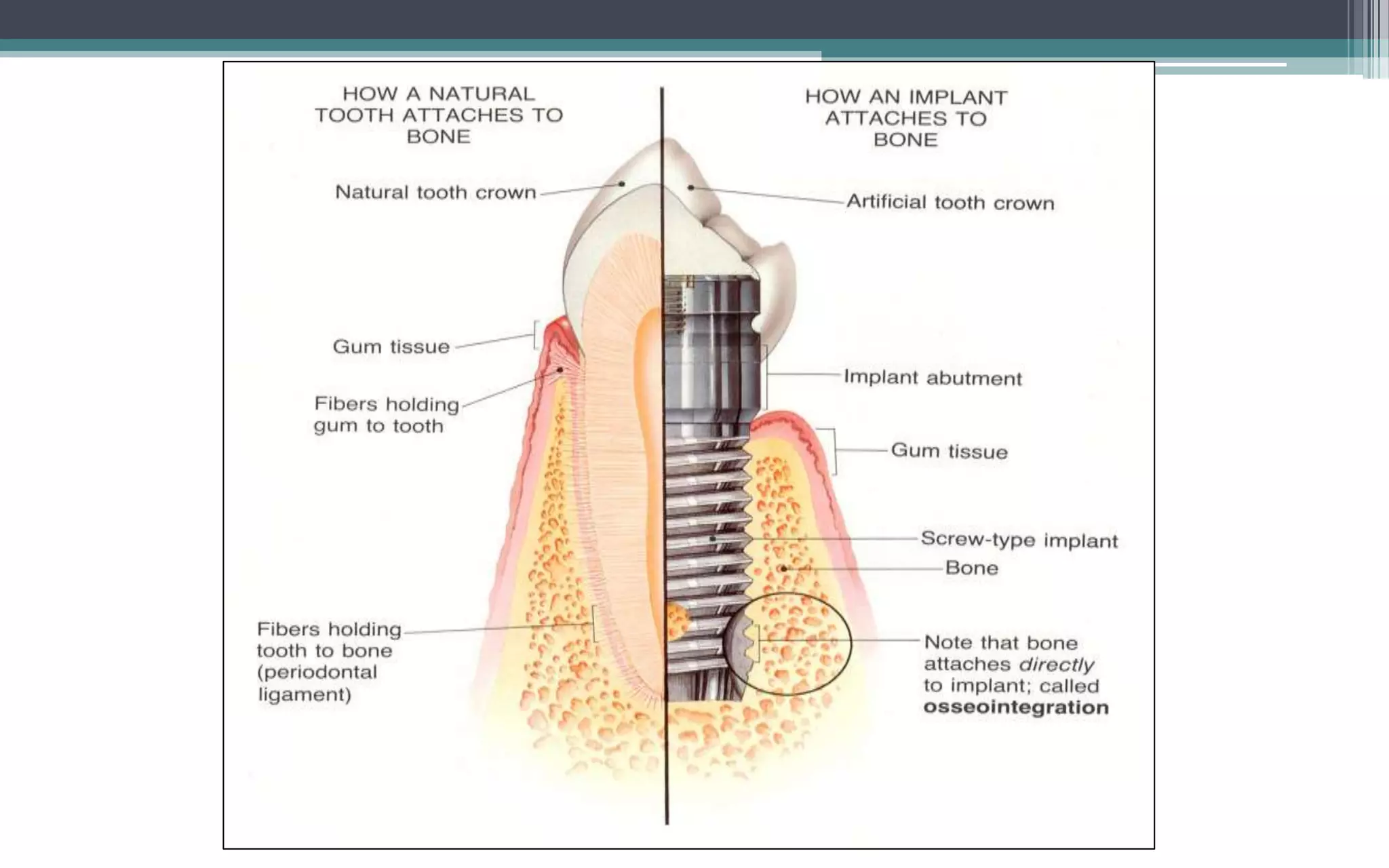 Impact of dental implant surface modifications on Osseo-integration | PPTX