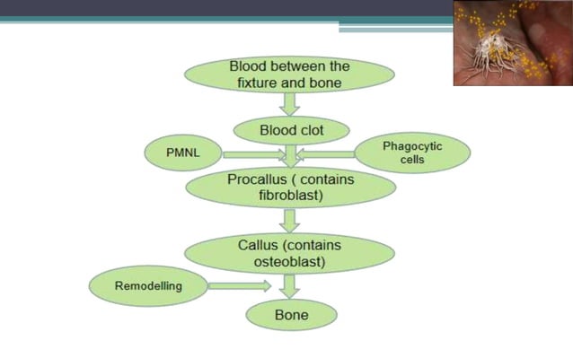 Impact of dental implant surface modifications on Osseo-integration ...