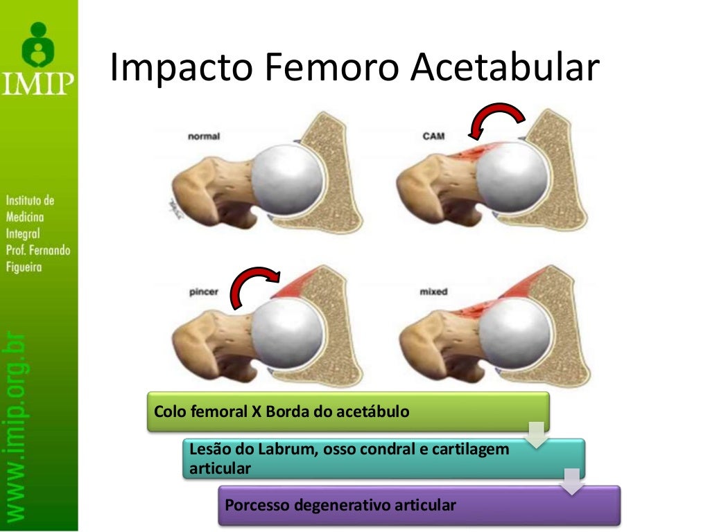Impacto femoro acetabular - Dr Leandro Freire