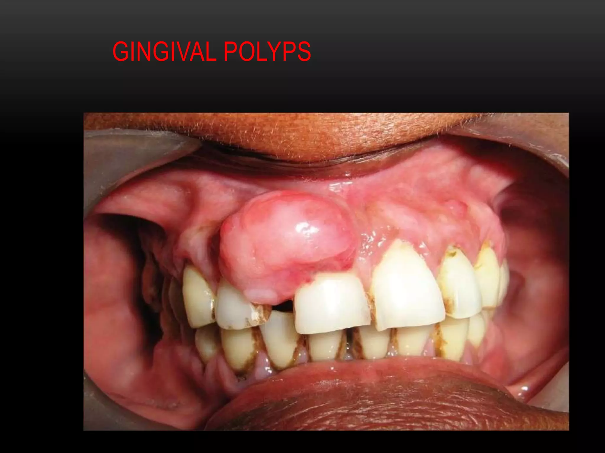 Impact of periodontal infection on systemic health By Dr Sachin Rathod ...