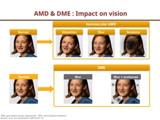 Impact of retinal disorders NP4-589784.pptx