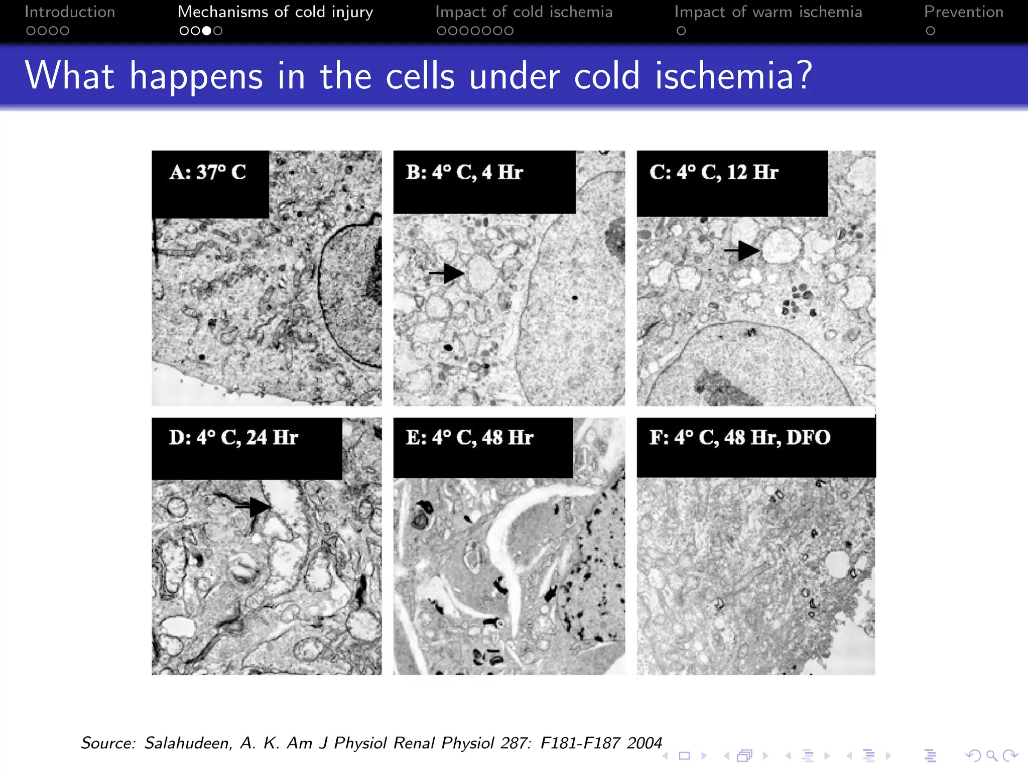 Impact Of Warm And Cold Ischemia Time On Kidney Transplantation | PDF