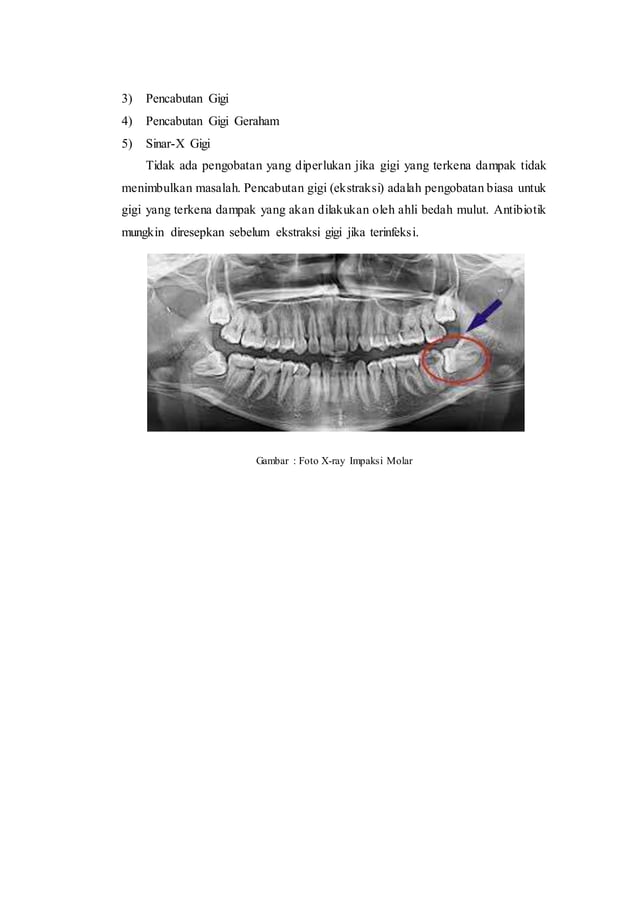 Impaksi maggie | DOCX