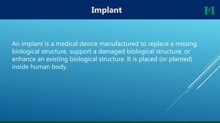 Implant | PPTX