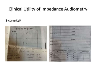 Impedance audiometry | PPTX