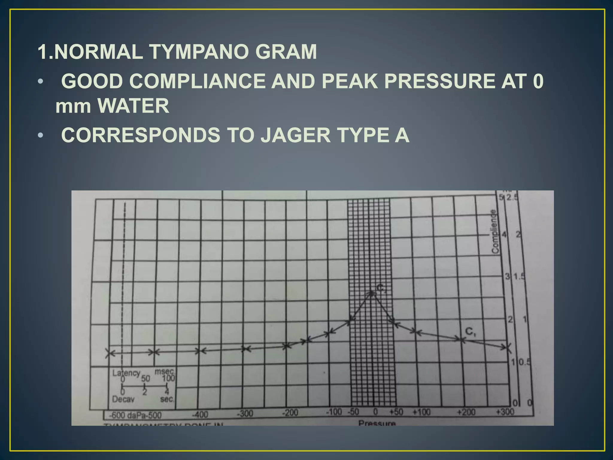 Impedance audiometry part 1 | PPTX