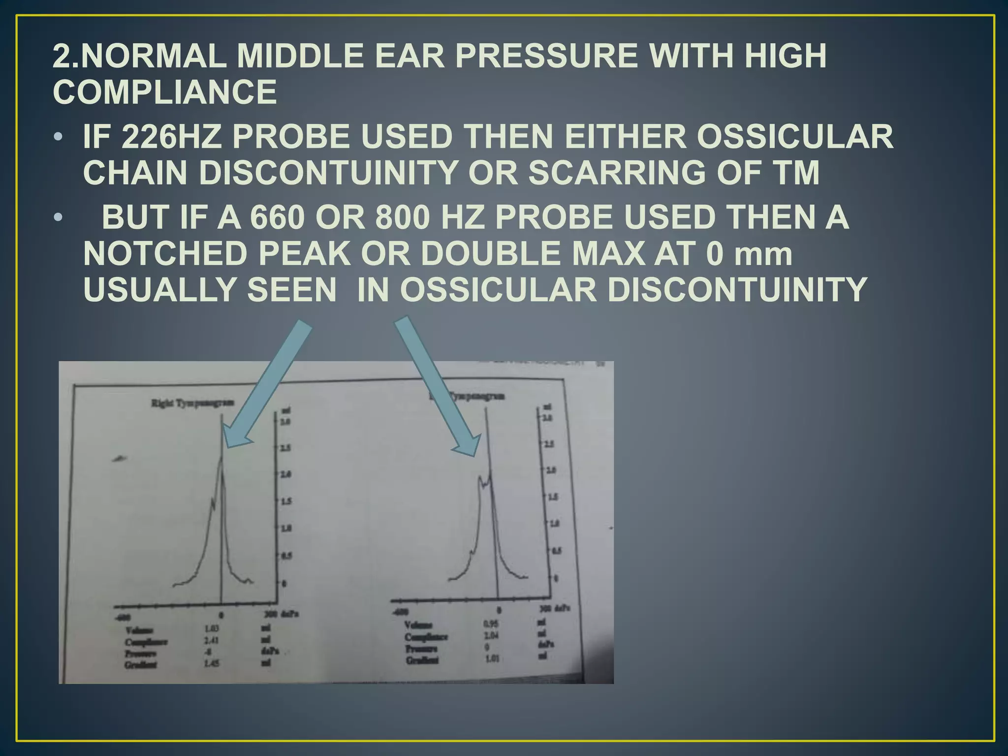 Impedance audiometry part 1 | PPTX