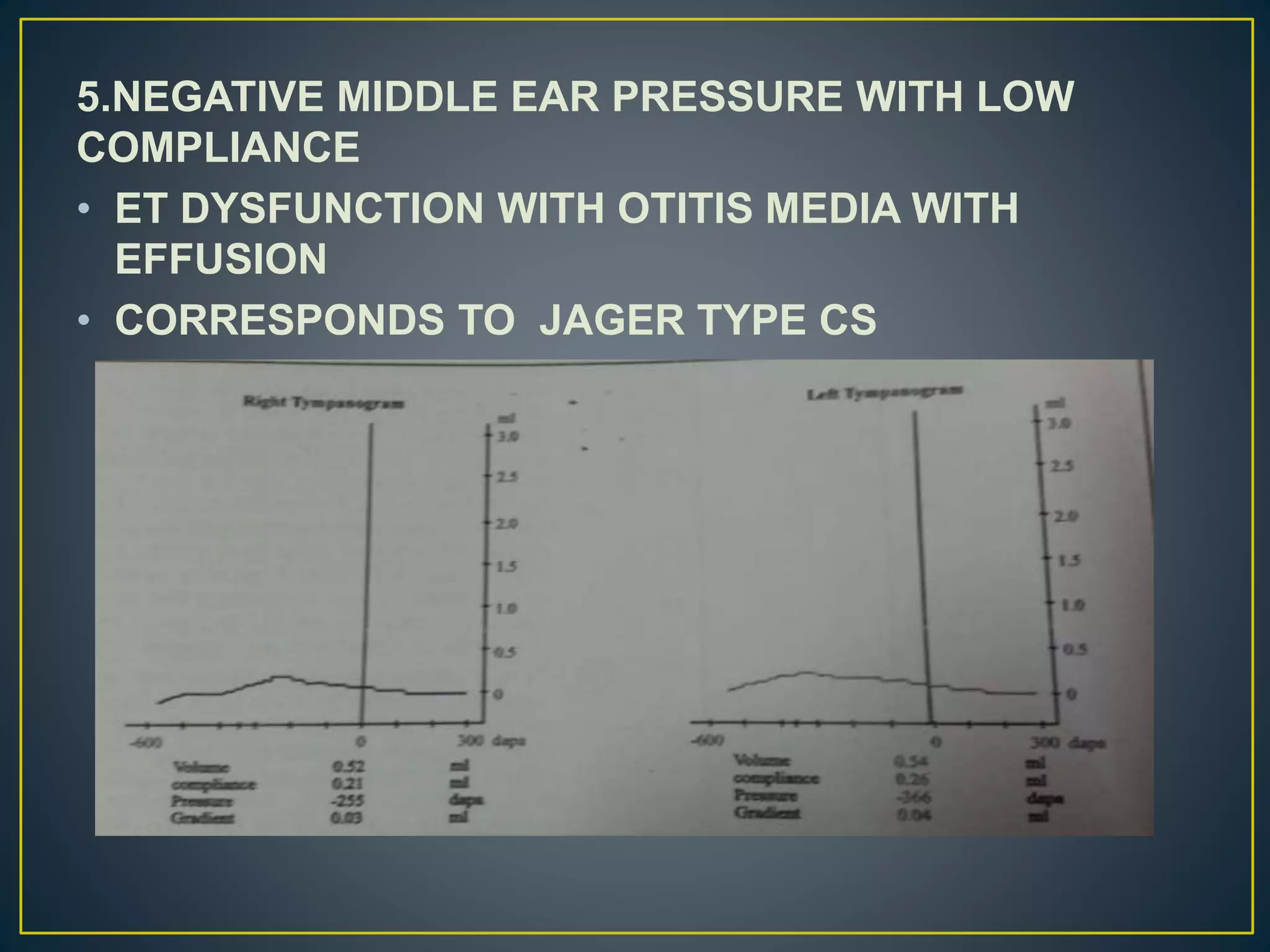Impedance audiometry part 1 | PPTX