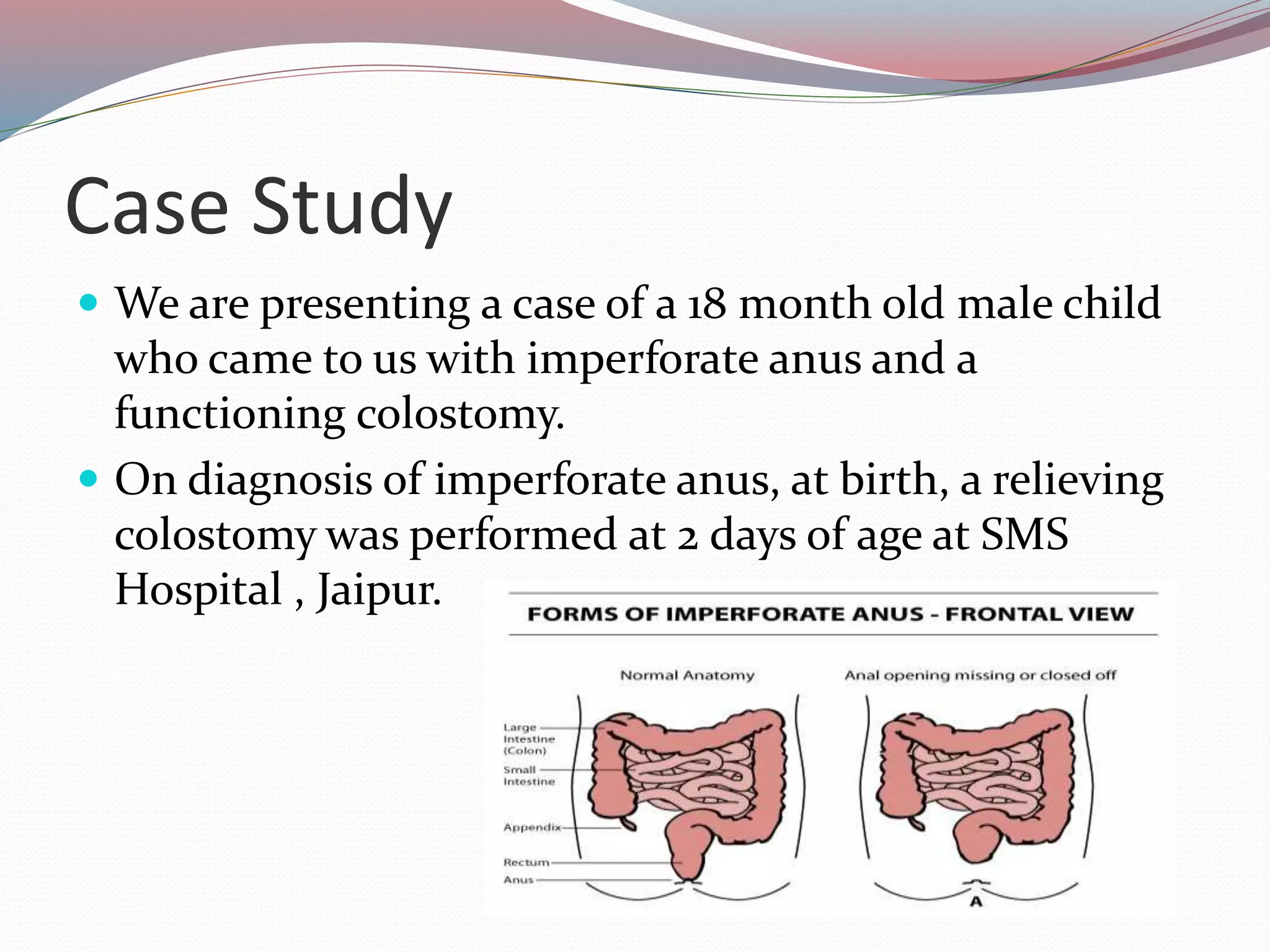 Imperforate Anus | PPTX