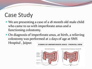 Imperforate Anus | PPTX