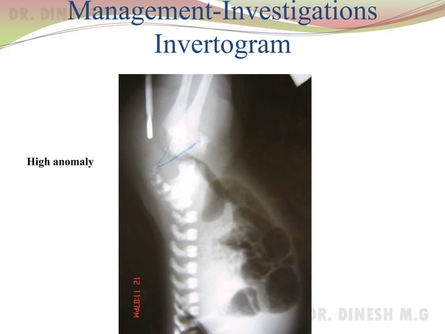 Imperforate Anus | PPT