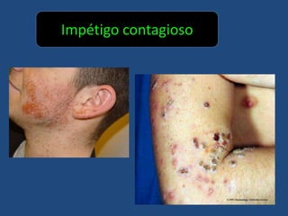 Impetigo | PPTX